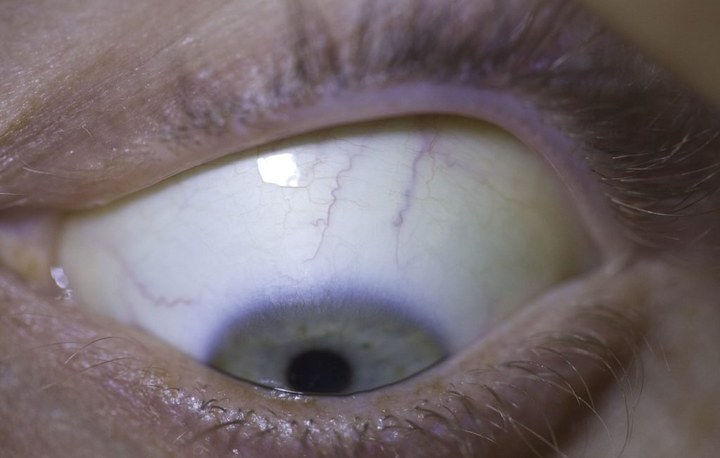 Enzyme Metabolism Dysfunction – Sclerology - Holistic Eye