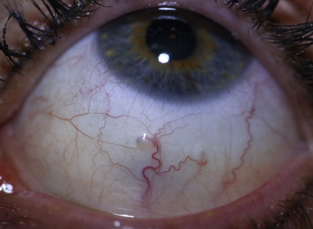 Encapsulation – Sclerology - Holistic Eye