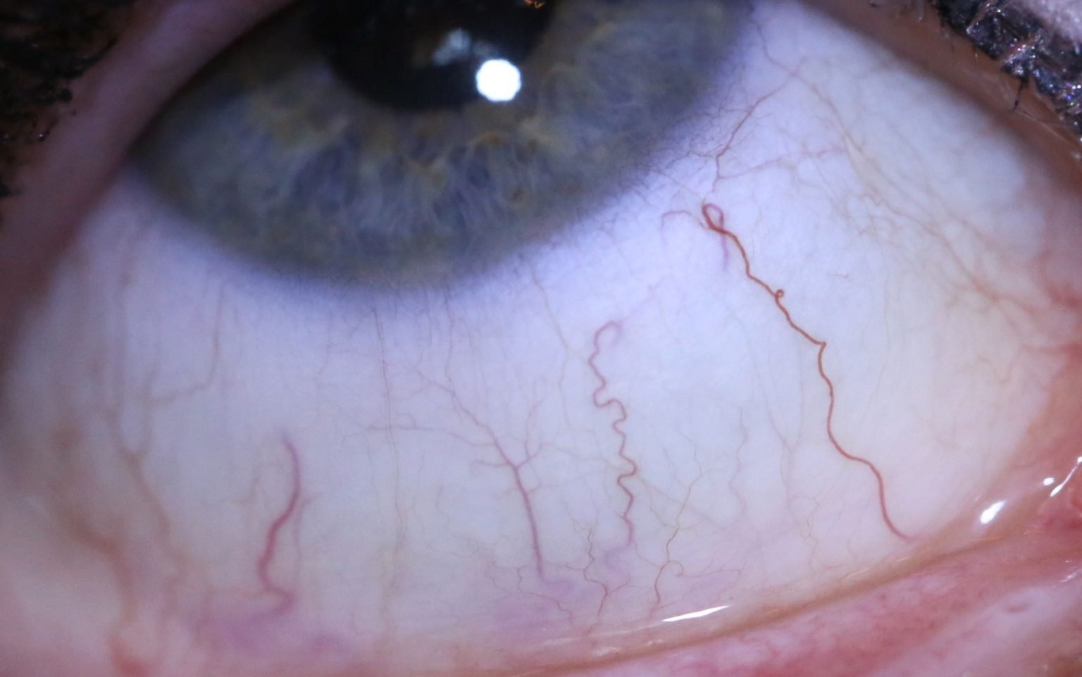 Sclera Markings - Holistic Eye